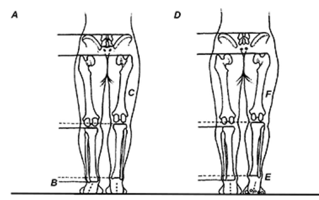 Managing Limb Length Discrepancies - Human Locomotion