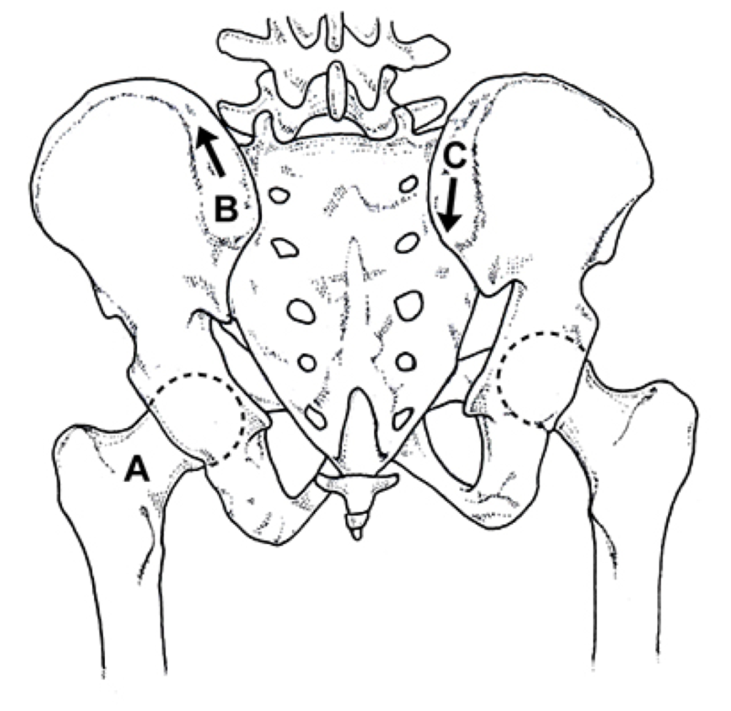 Managing Limb Length Discrepancies - Human Locomotion