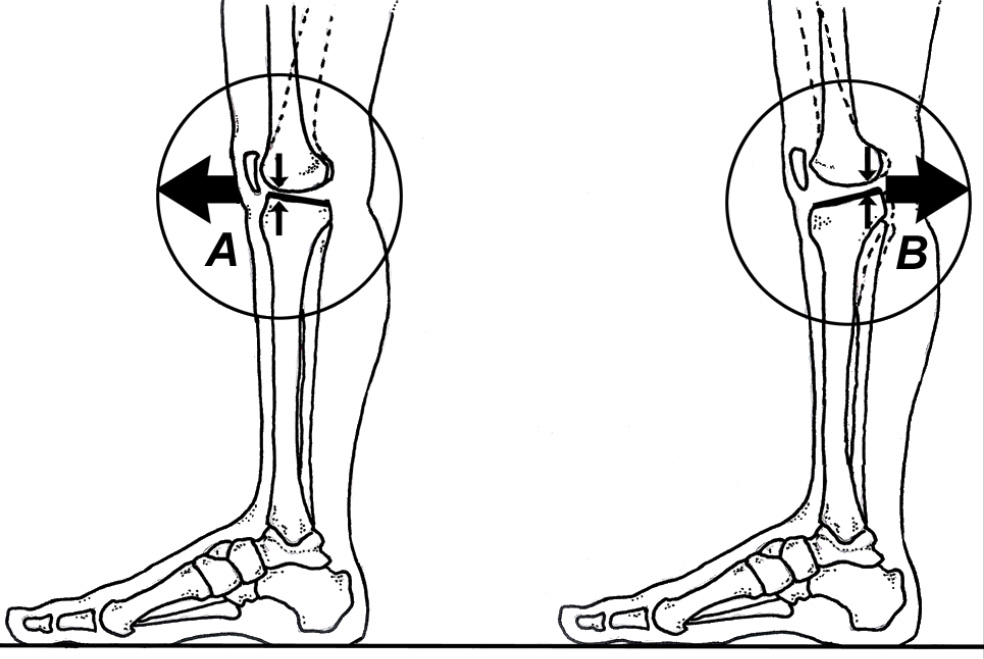 Gait Retraining for Knee Hyperextension - Human Locomotion