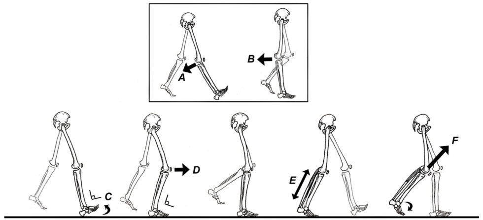 Gait Retraining for Knee Hyperextension - Human Locomotion