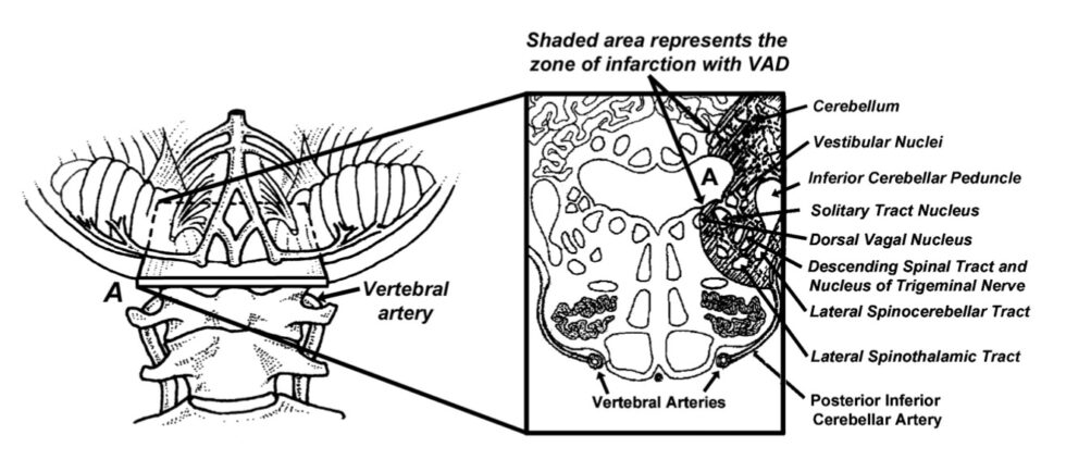 In-Office Screening to Rule Out Vertebral Artery Dissection - Human ...