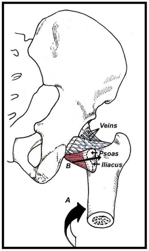 The Surprising Connection Between Tight Hip Flexors and Painful Hip ...