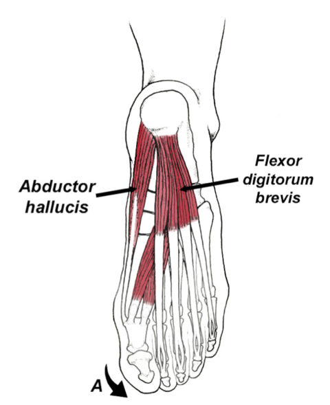 Varus and Valgus Insole Posting: An Inexpensive and Effective ...