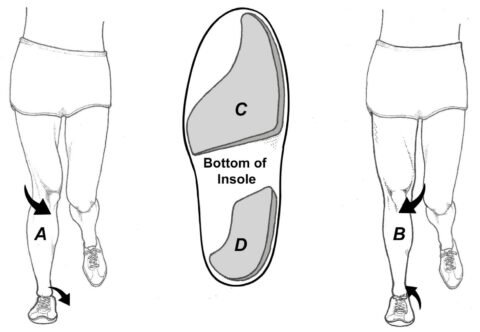Varus and Valgus Insole Posting: An Inexpensive and Effective ...