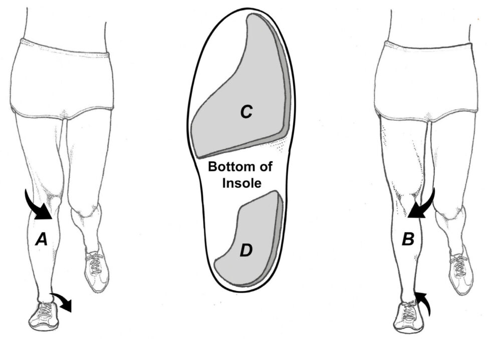 Varus and Valgus Insole Posting: An Inexpensive and Effective ...