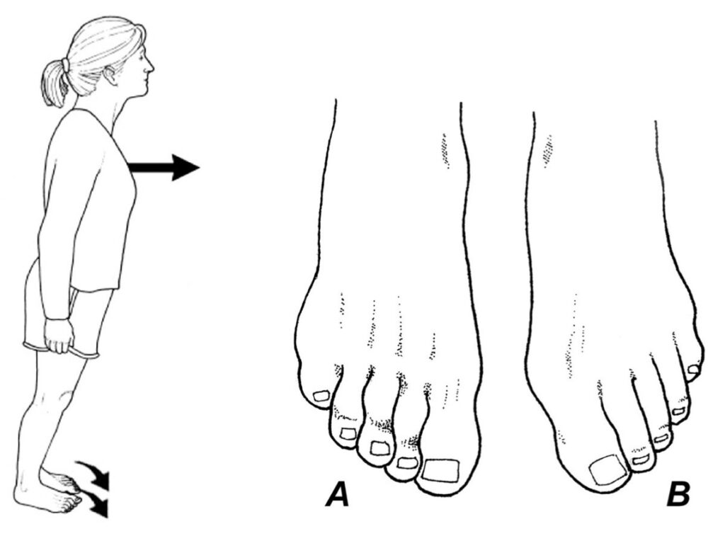 The Positive Wink Sign: A New Diagnostic Test for Evaluating Toe Flexor ...