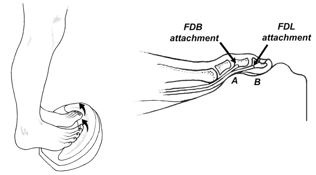 The Positive Wink Sign: A New Diagnostic Test for Evaluating Toe Flexor ...