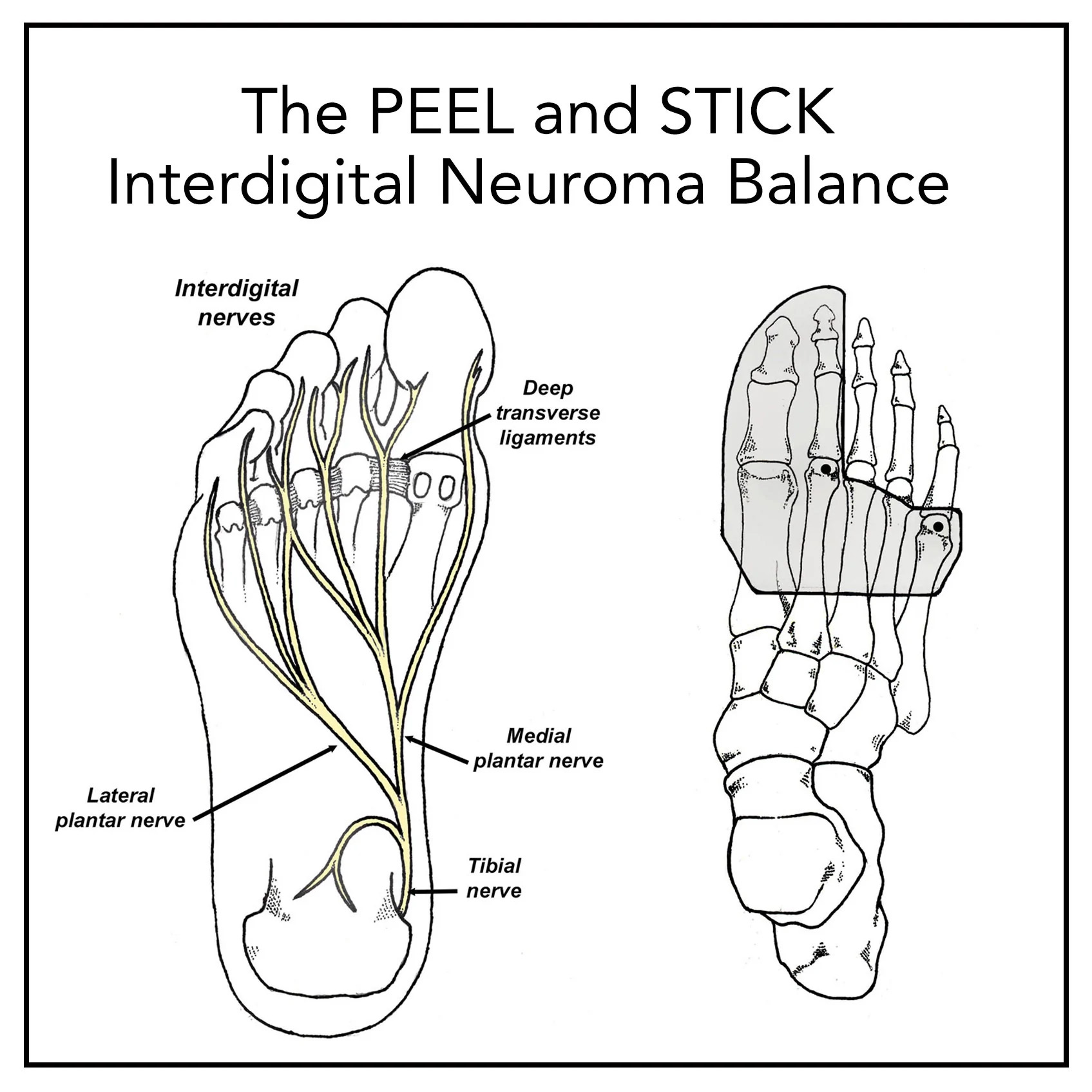 PEEL AND STICK BALANCES: The Interdigital Neuroma Balance - Human ...