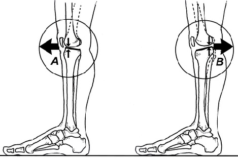 Popliteus Tendinitis: Biomechanical Factorsand Conservative Treatment ...