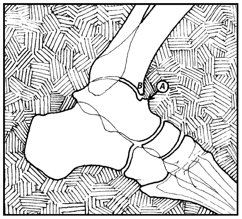Anteromedial Ankle Impingement Syndrome - Human Locomotion