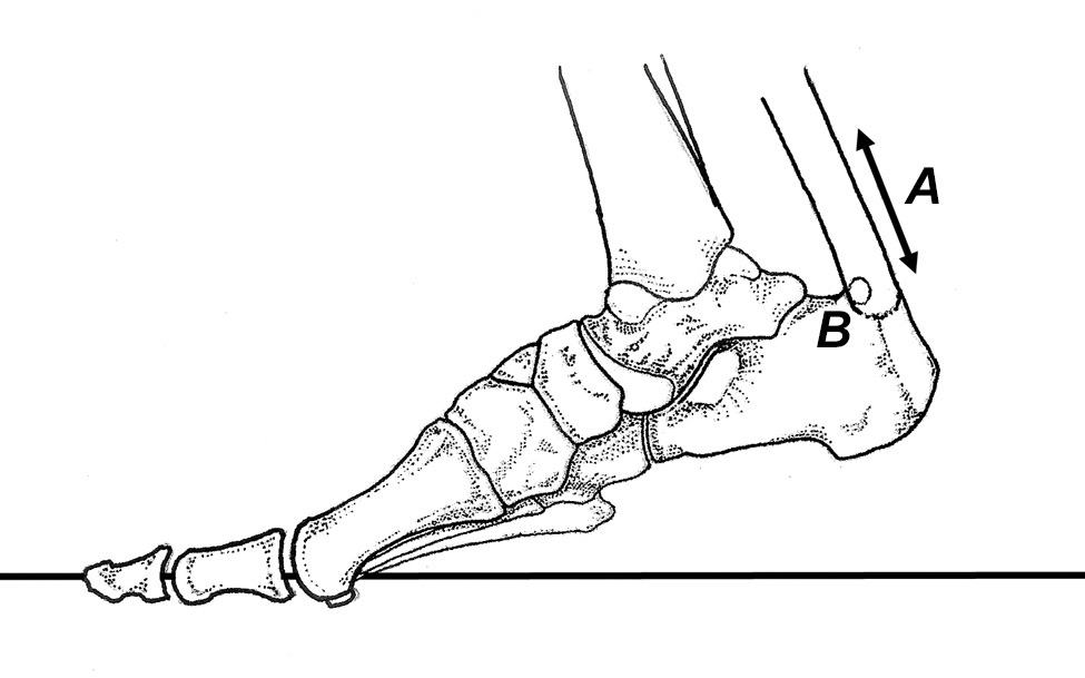 The Ideal Exercises for Managing Insertional Achilles Injuries - Human ...