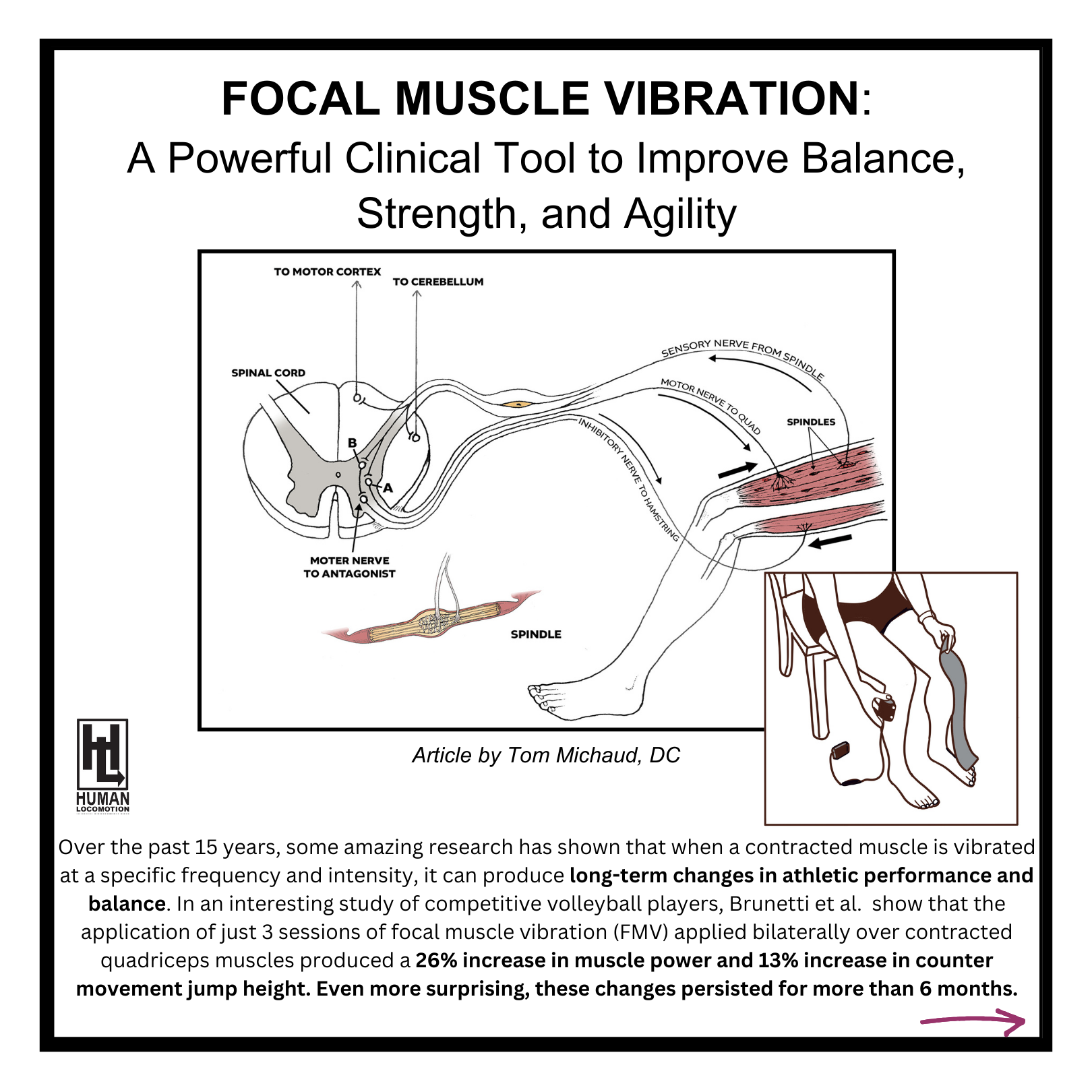 Focal Muscle Vibration: A Powerful Clinical Tool to Improve Balance ...