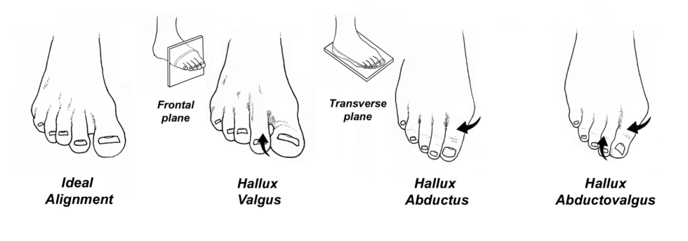 How to Prevent and Even Reverse the Formation of Bunions Without ...