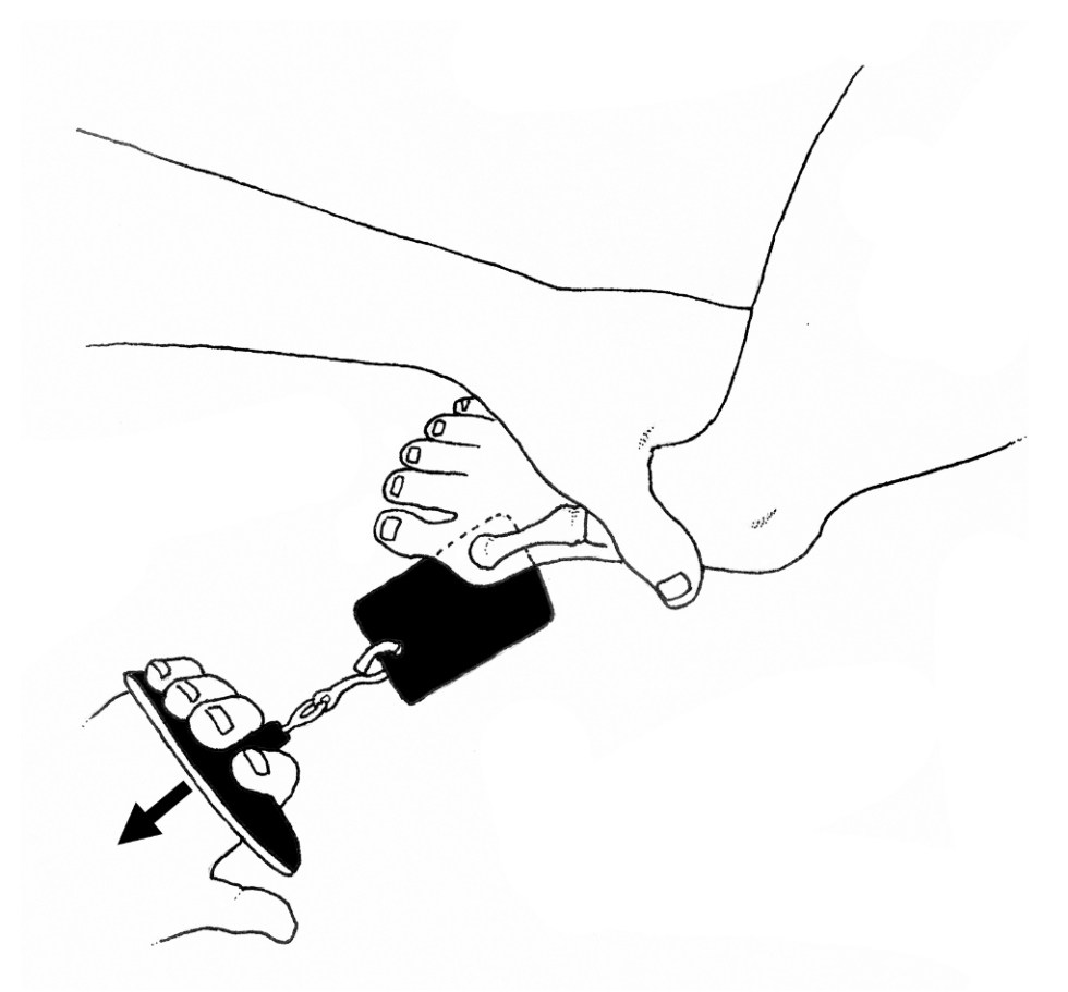 How to Prevent and Even Reverse the Formation of Bunions Without ...