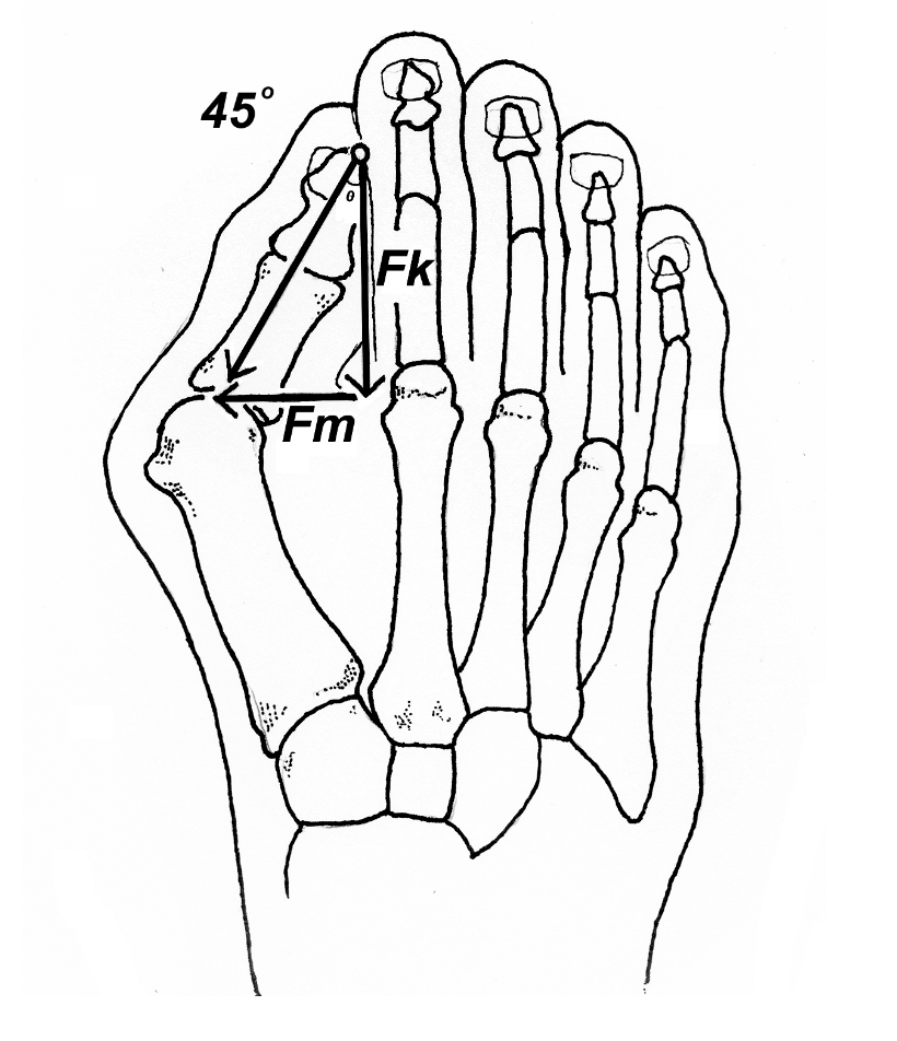 How to Prevent and Even Reverse the Formation of Bunions Without ...