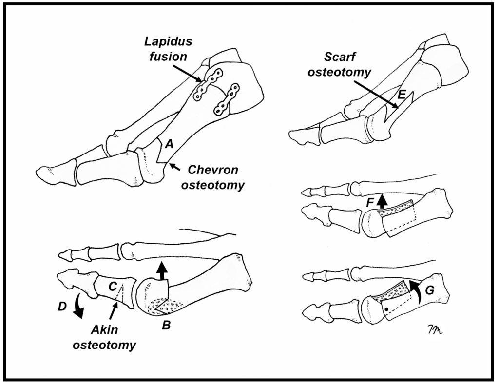 How to Prevent and Even Reverse the Formation of Bunions Without ...