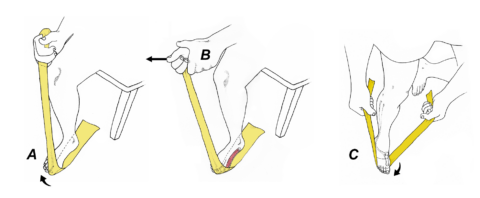 How to Prevent and Even Reverse the Formation of Bunions Without ...