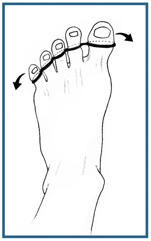 How to Prevent and Even Reverse the Formation of Bunions Without ...