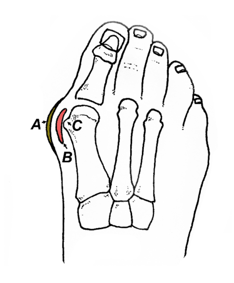 How to Prevent and Even Reverse the Formation of Bunions Without ...
