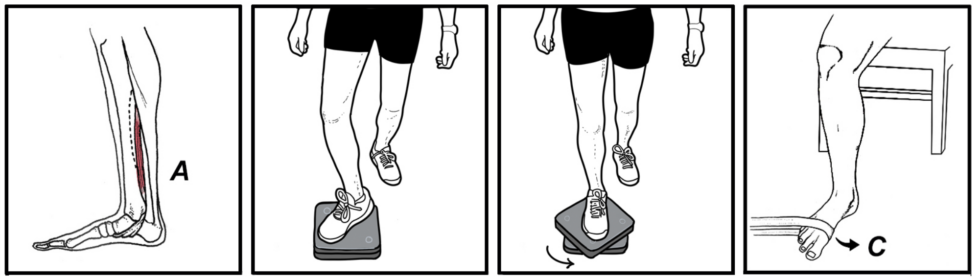 How to Prevent and Even Reverse the Formation of Bunions Without ...