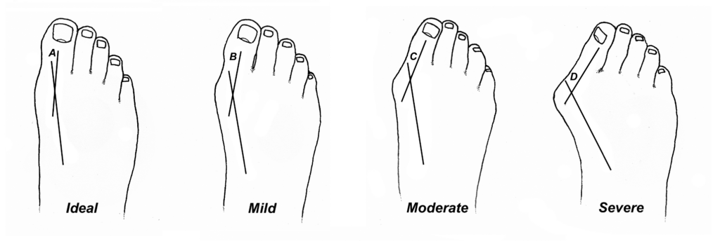How to Prevent and Even Reverse the Formation of Bunions Without ...