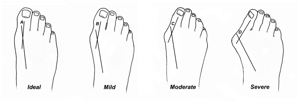 How to Prevent and Even Reverse the Formation of Bunions Without ...