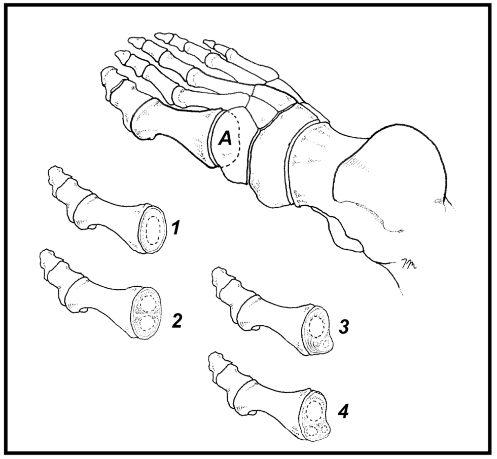 How to Prevent and Even Reverse the Formation of Bunions Without ...