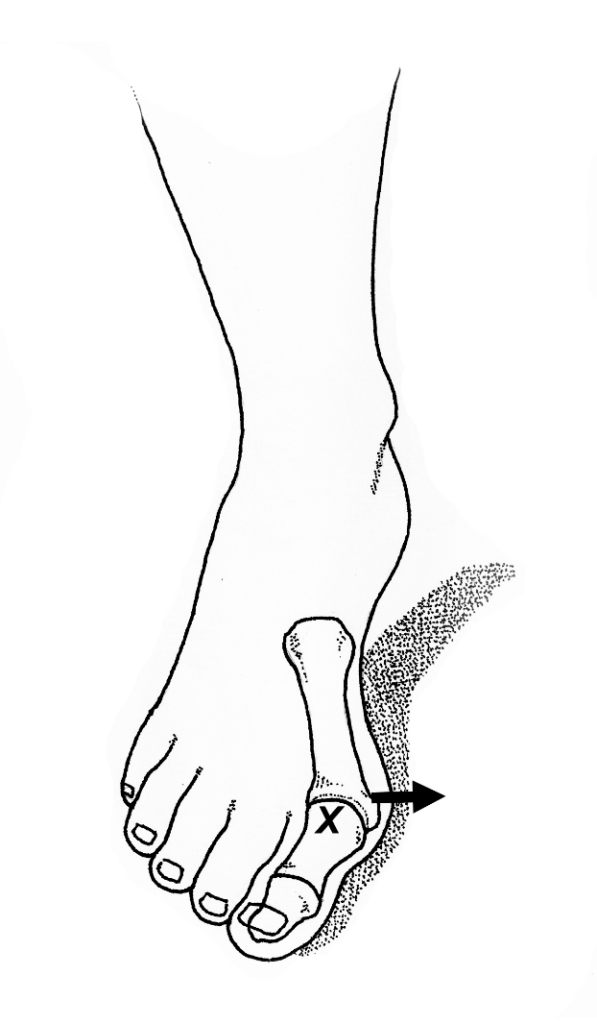 How to Prevent and Even Reverse the Formation of Bunions Without ...