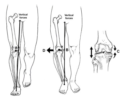 Bowed Legs and Knee Arthritis: The Importance of Maintaining Hip ...