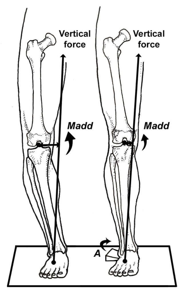 Bowed Legs and Knee Arthritis: The Importance of Maintaining Hip ...