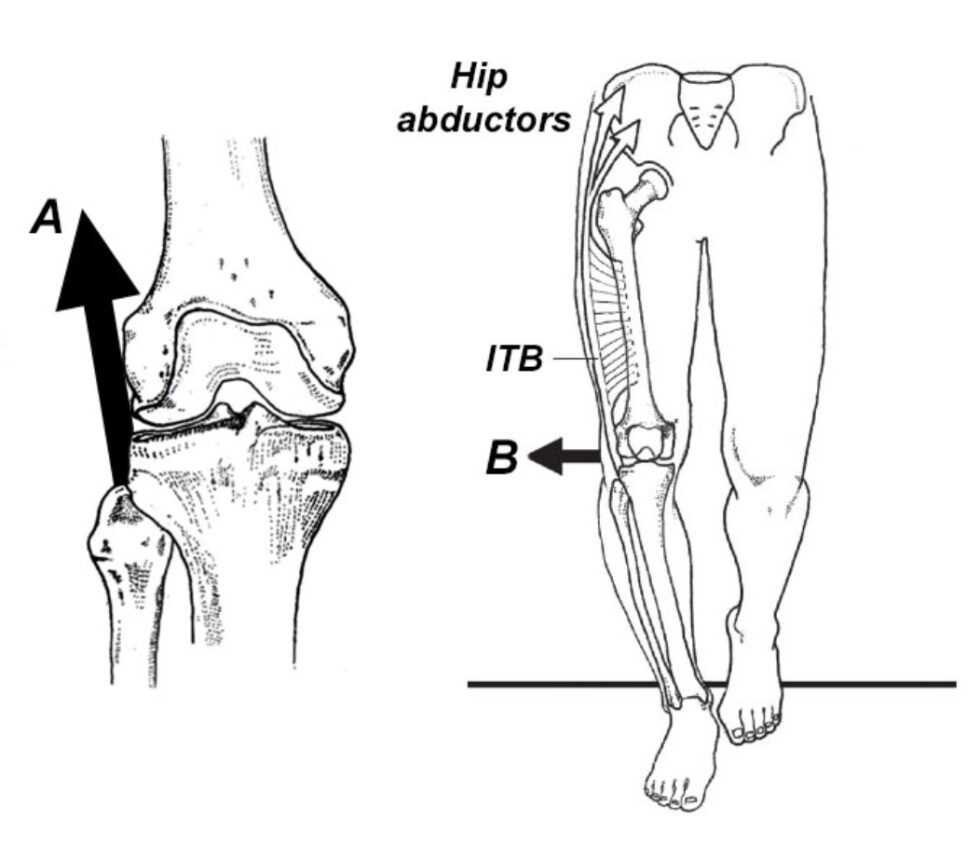 Bowed Legs and Knee Arthritis: The Importance of Maintaining Hip ...