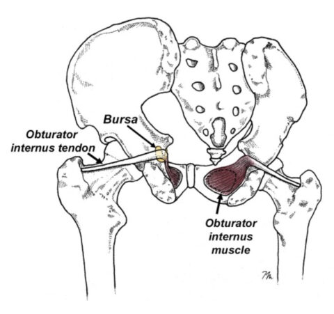 Obturator Internus Contracture: An underappreciated cause of pelvic ...