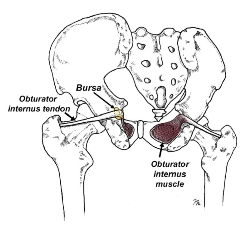 Obturator Internus Contracture: An underappreciated cause of pelvic ...