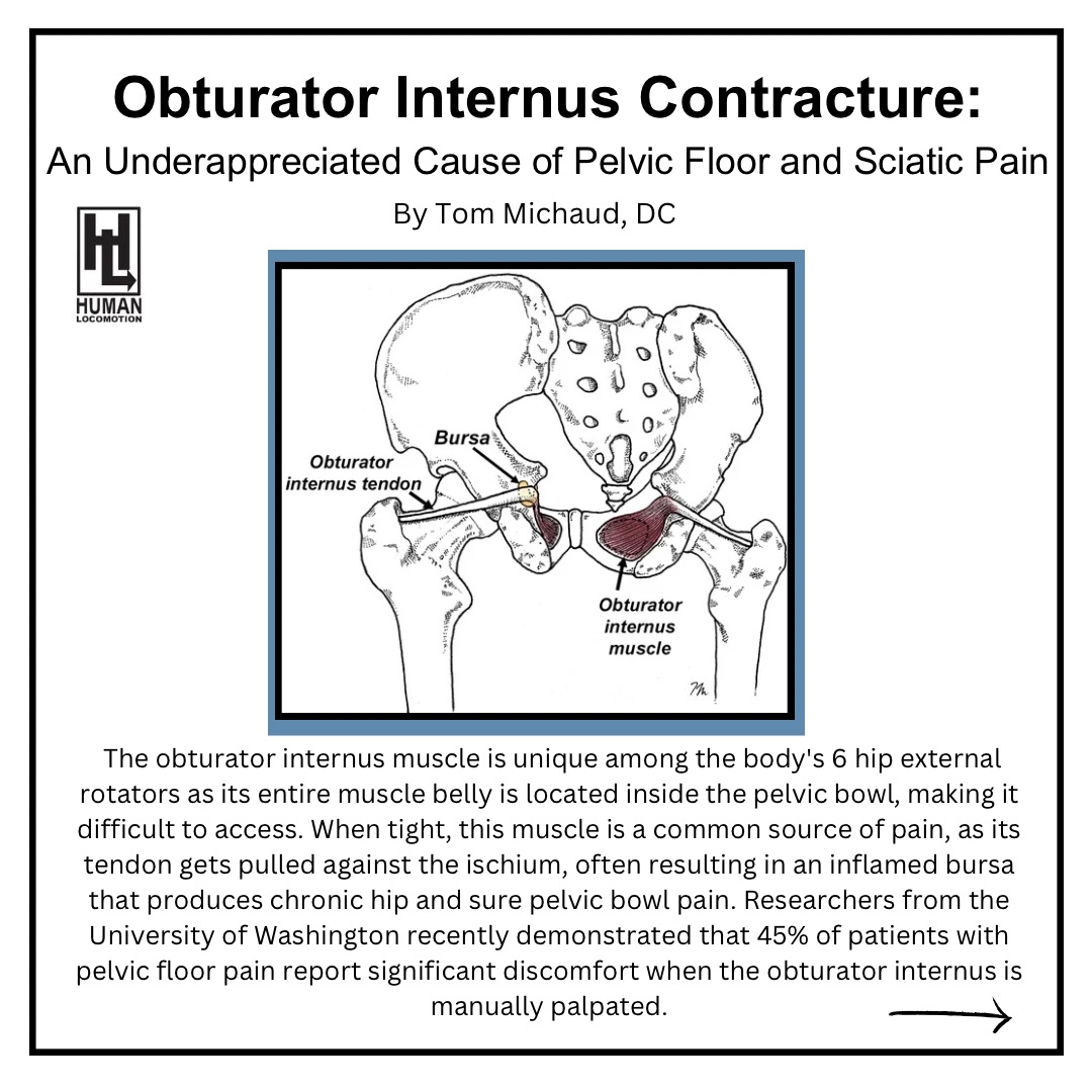 Obturator Internus Contracture: An underappreciated cause of pelvic floor and sciatic pain ...