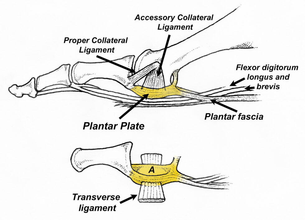 The Conservative Management of Plantar Plate Injuries - Human Locomotion