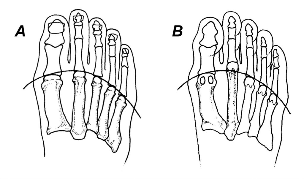 The Conservative Management of Plantar Plate Injuries - Human Locomotion