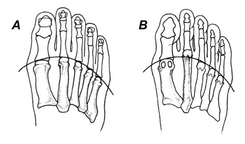 The Conservative Management of Plantar Plate Injuries - Human Locomotion