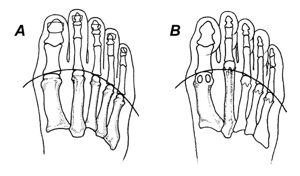 The Conservative Management of Plantar Plate Injuries - Human Locomotion