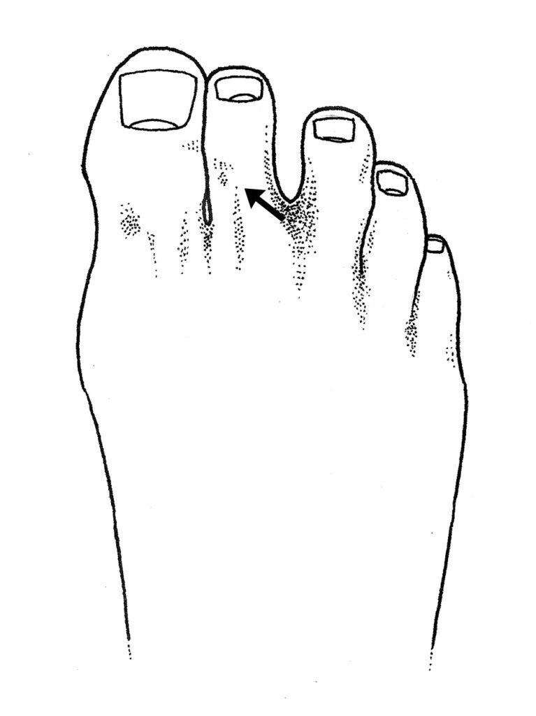 The Conservative Management of Plantar Plate Injuries - Human Locomotion