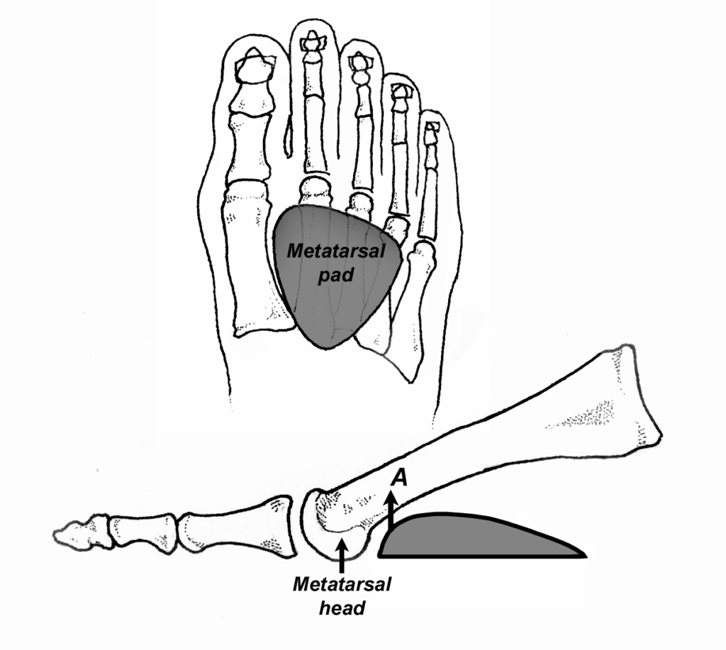 The Human Locomotion Metatarsal Pad - Human Locomotion