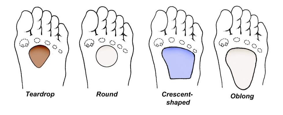 The Human Locomotion Metatarsal Pad - Human Locomotion