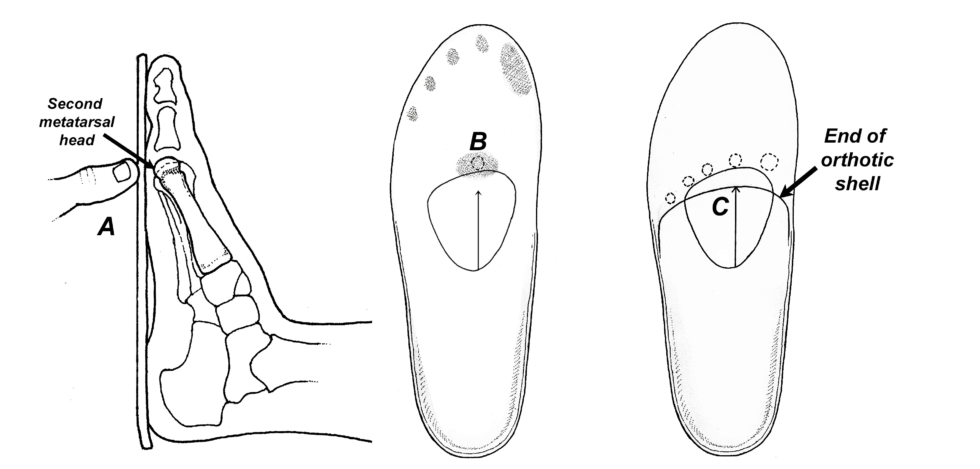 The Human Locomotion Metatarsal Pad - Human Locomotion